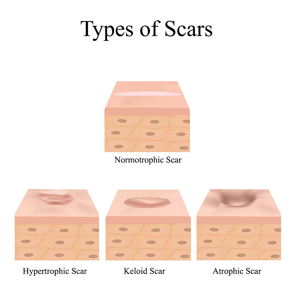 Healing Scars with Infrared Saunas